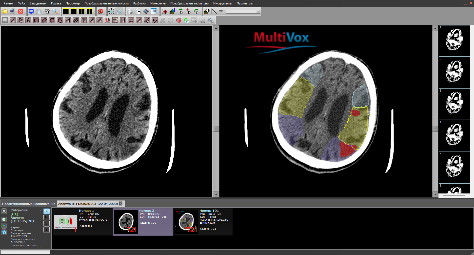 Программа «Multivox ASPECTS» для диагностики ишемического инсульта по ...